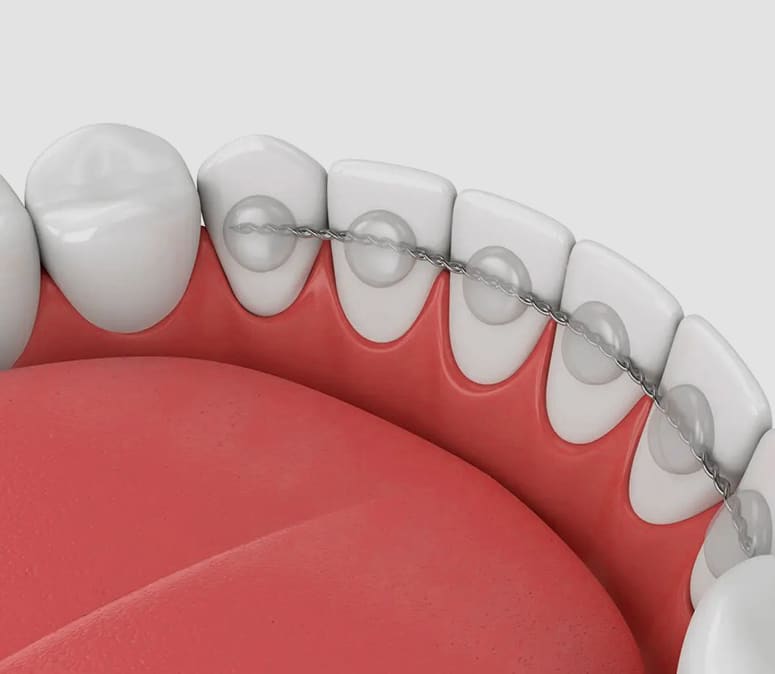 Dental Bonding in Bellevue PA - Monda & Weiss Family Dentistry