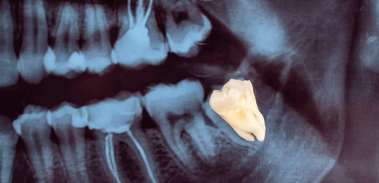 Wisdom Tooth Extraction Aftercare Tips and Guide
